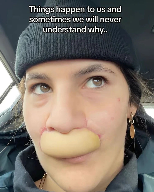 Model’s Lip Was Bitten Off by a Pit Bull – Her Inspiring Journey of ...