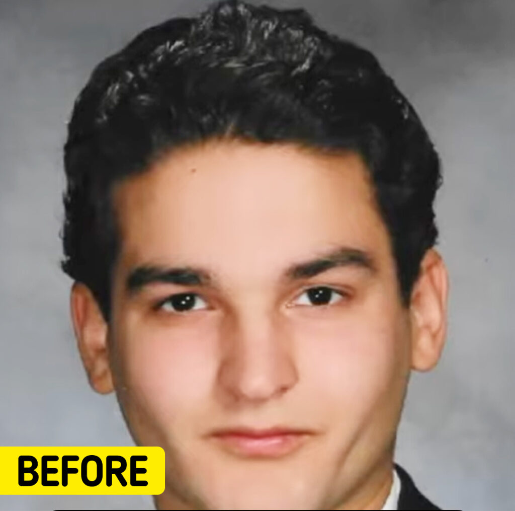 Man Who Underwent a Full Face Transplant Finds True Love and Shares an ...